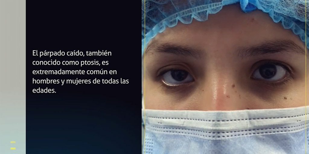 Cirugía De Párpado Caído Sin Cicatriz Segura Rápida Y Efectiva Arte