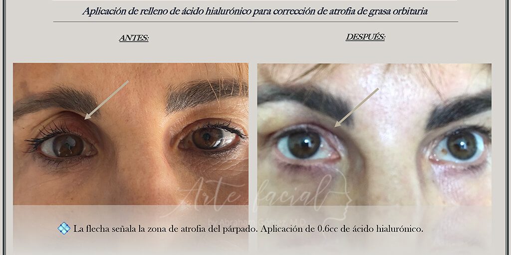 Cara Con Cicatriz En El Ojo Personajes Con Cicatrices/lesiones En Los