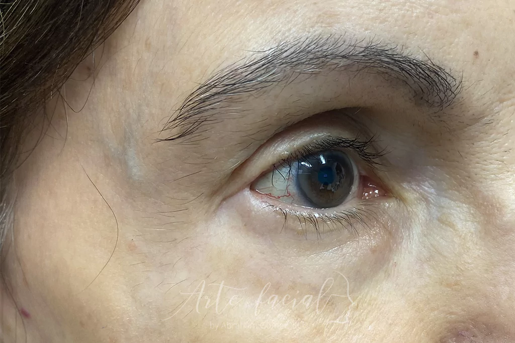 Eyelid reconstruction after Mohs surgery in Costa Rica